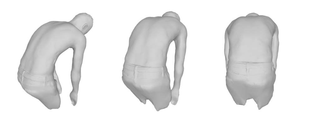 Diagnosing and monitoring scoliosis using 3D scan from smartphones ...